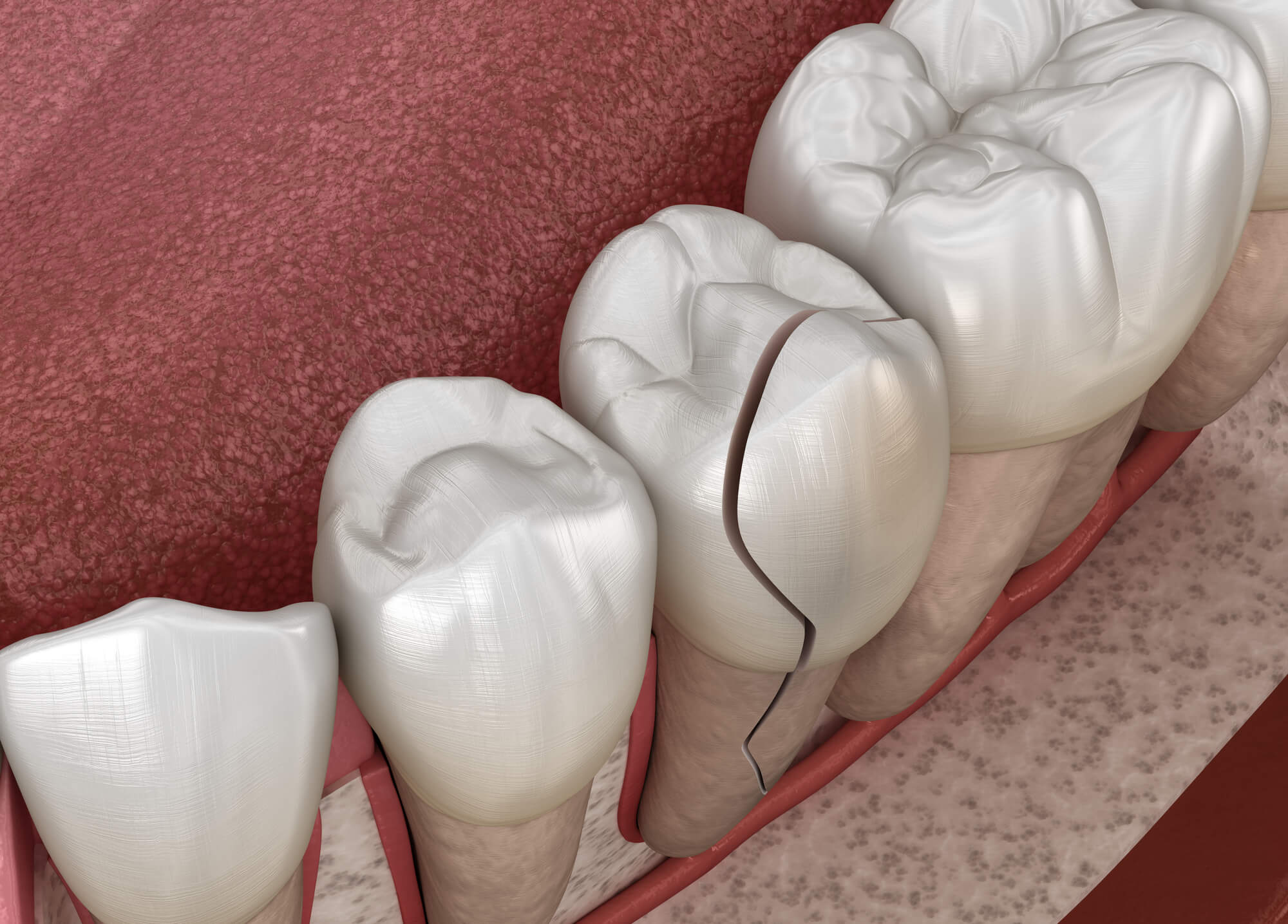Best Treatments for a Broken Tooth | Fix & Restore Your Smile